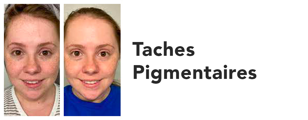 En direct facial taches pigmentaires